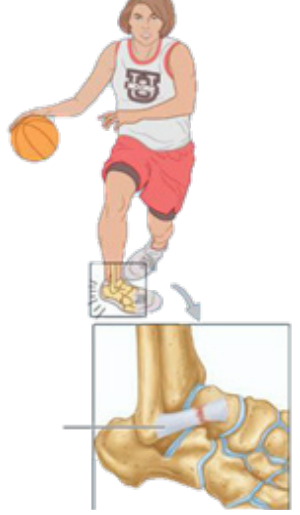 Entorses: definição, epidemiologia, mecanimos de lesão, tratamento e ...