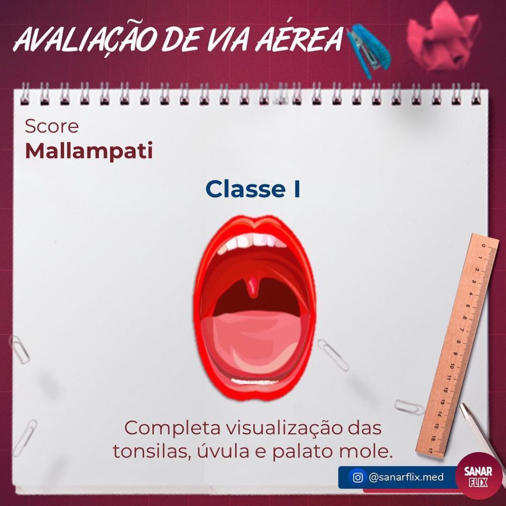 Escala de Mallampati - Sanarmed