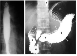 Avaliação radiológica do trato gastrointestinal | Colunistas - Sanarmed
