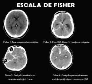 Classificação de Fisher: você sabe usar? | Colunistas - Sanarmed