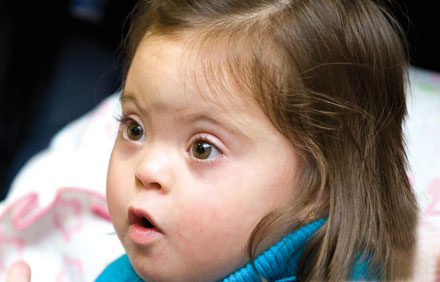 Características da síndrome de Down | Colunistas - Sanarmed