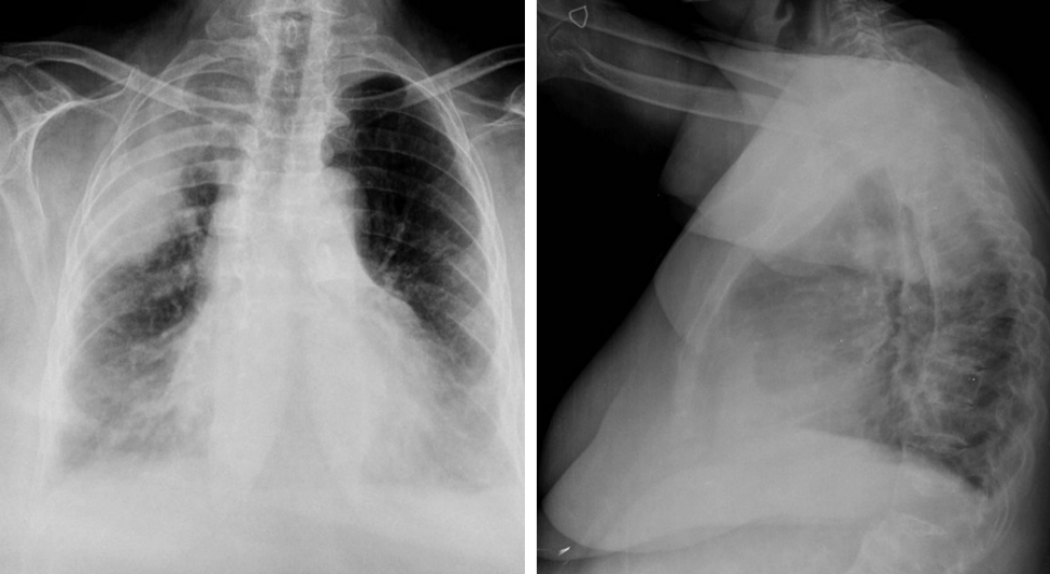 Caso clínico de Pneumonia - Sanarmed