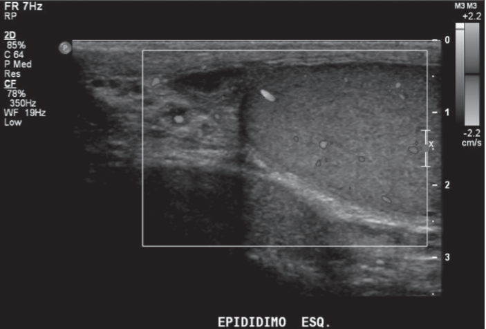 Casos Clínicos: Epididimite - Sanarmed