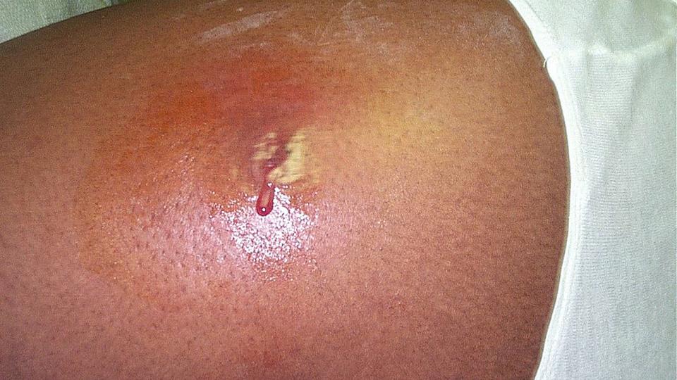 Resumo sobre Staphylococcus aureus (completo) – Sanarflix - Sanarmed