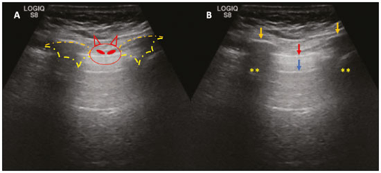 POCUS na abordagem da Dispneia - Sanarmed