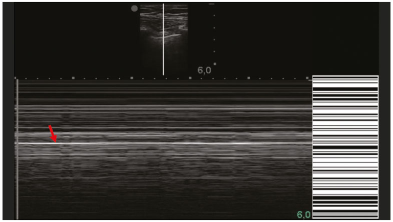 POCUS na abordagem da Dispneia - Sanarmed