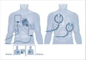 PCR: como reconhecer, manejar e cuidados pós Parada Cardiorrespiratória ...