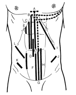 Abdominal Incisions Kocher Midline Incision Wall Mercedes Paramedian ...