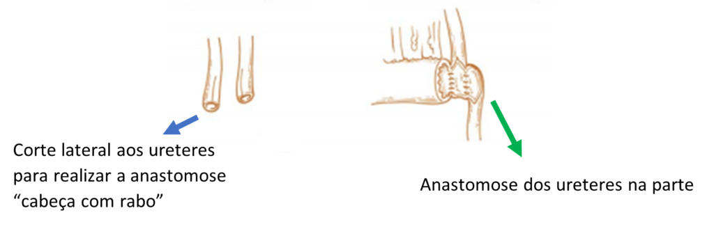 Técnica de Bricker | Colunistas - Sanarmed