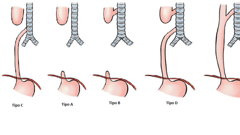 Atresia de esôfago: Uma visão geral | Colunistas - Sanarmed
