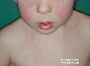 Doenças Exantemáticas: Eritema Infeccioso e Exantema Súbito ...