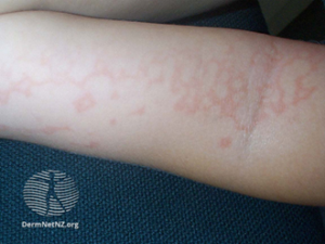 Doenças Exantemáticas: Eritema Infeccioso e Exantema Súbito ...