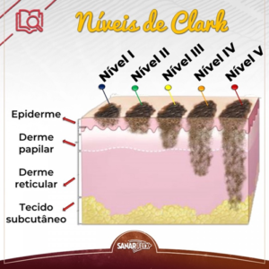 Níveis de clark | Colunistas - Sanarmed