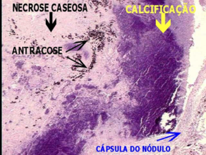 Acúmulos intracelulares e calcificações patológicas | Colunistas - Sanarmed