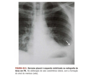 Como diagnosticar o derrame pleural nos exames de imagem? | Colunistas ...