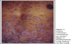 Resumo de síndrome de reiter: epidemiologia, fisiopatologia ...