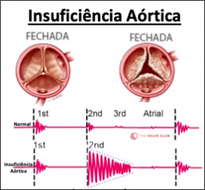 Endocardite Infecciosa: aspecto geral, diagnóstico, tratamento e ...