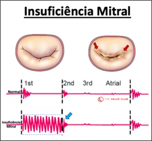 Endocardite Infecciosa: aspecto geral, diagnóstico, tratamento e ...