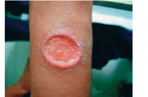 Leishmaniose Tegumentar Americana | Colunistas - Sanarmed