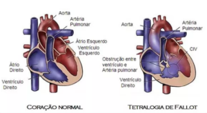 Tetralogia de Fallot: fisiopatologia, diagnóstico e tratamento - Sanarmed
