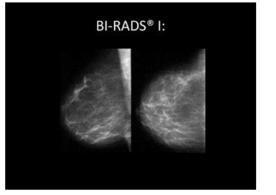 Classificação BIRADS e a importância da mamografia na detecção do ...