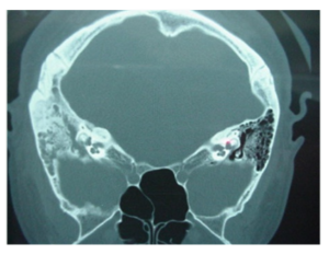 Mastoidite: infecção da mastoide | Colunistas - Sanarmed