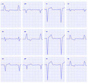 Bloqueio de Ramos Intraventriculares: como identificar no ECG ...