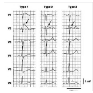 Bloqueio do ramo direito – vilão ou mocinho? Como anamnese pode ajudar ...