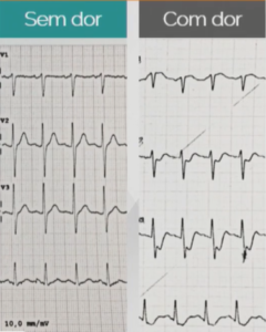Síndrome Coronariana Aguda (SCA): como manejar o paciente na sala de ...