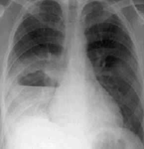 Radiografia de tórax: principais achados nas doenças pulmonares - Sanarmed
