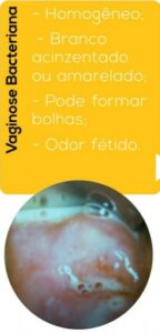 Dica de ginecologia: tudo sobre diagnóstico de corrimento vaginal ...