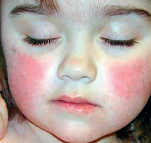 Doenças exantemáticas: tipos, quadro clínico, diagnóstico e mais - Sanarmed