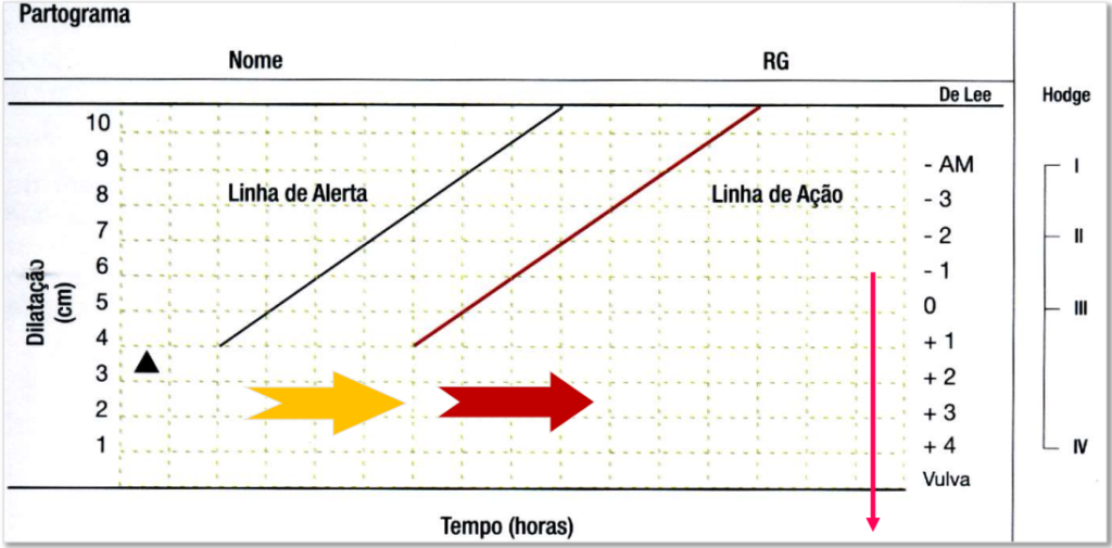 Partograma: o que é, sua importância e como preenchê-lo - Sanarmed