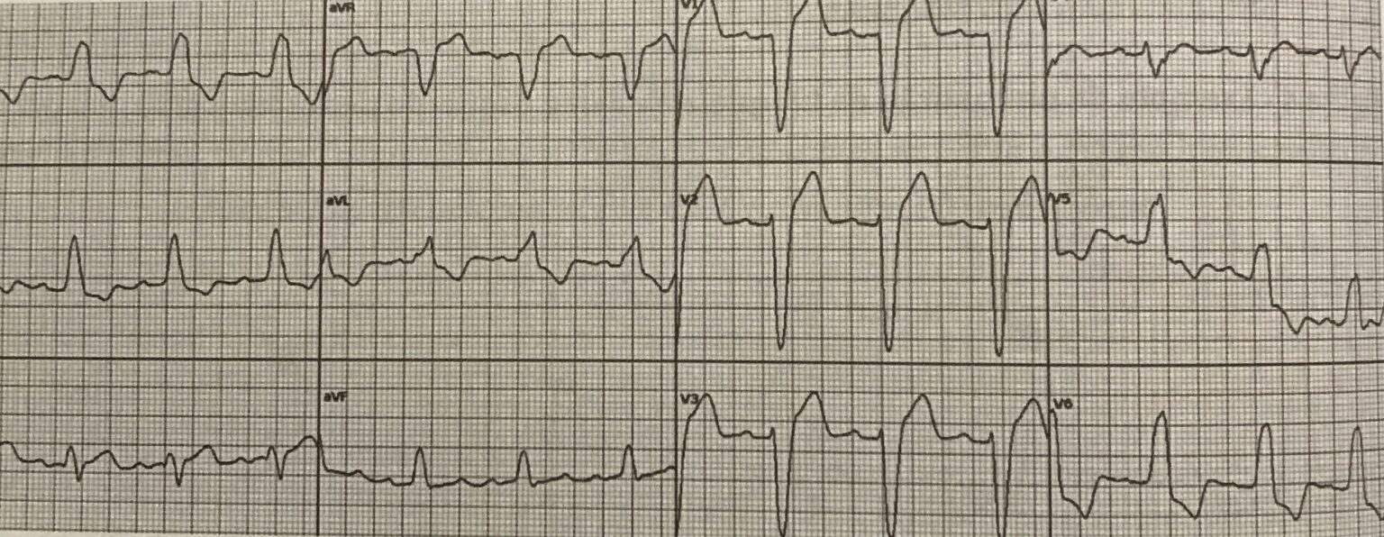 ECG dos bloqueios de ramo e divisionais - Sanar Medicina